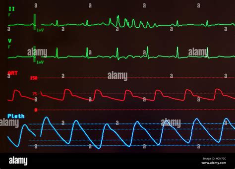 Ecg Heart Monitor