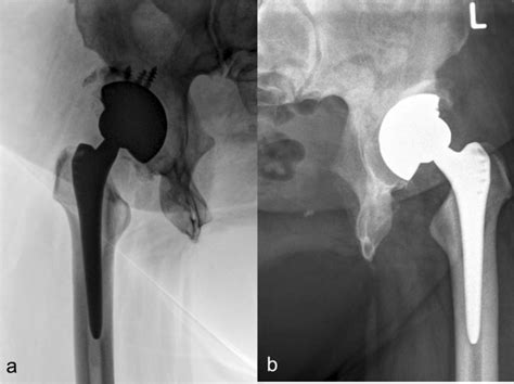 A Postoperative Radiography Of The Right Hip With The Osteoconductive Download Scientific