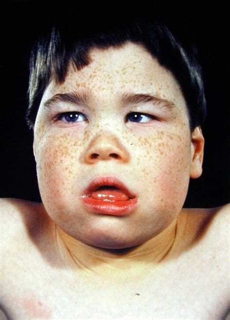 Artx Syndrome Understanding A Rare X Linked Intellectual Disability Overseas Doctor