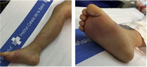 Multifocal Necrotizing Fasciitis Due To Streptococcus Pyogenes Anales De Pediatría