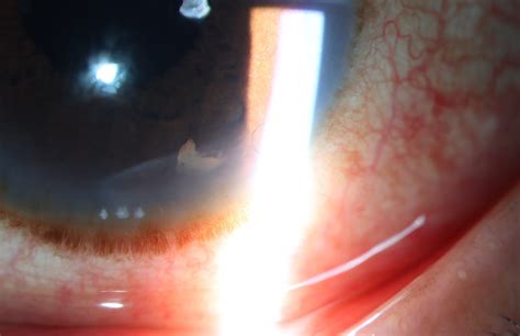 Retained Lens Fragment