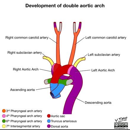 Left Sided Aortic Arch Aortic Arch Syndrome Information Ljnn