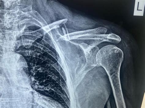 Dr Sabyasachi Bardhan Dnb Ortho Mnams Ao Masters On Linkedin Plate Fixation For Segmental