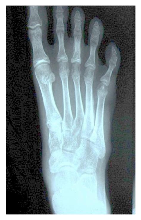 Tuberculous Dactylitis An Uncommon Presentation Of A Common Infection