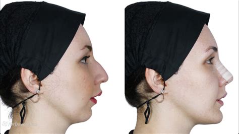 ارتوسرجری عقب بودن فک پایین دکتر داودیان