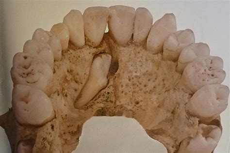 Cuspid Teeth Impaction At Esther Parr Blog