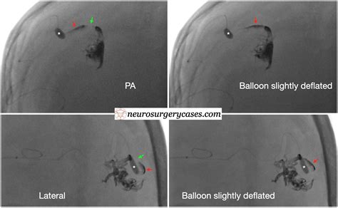 Embolization Avm