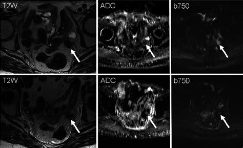 Diffusion Weighted Mri Used In Treatment Response Monitoring Top Row Download Scientific