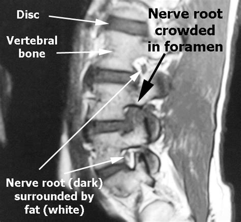 Mri Foraminal Stenosis A Practical Mri Grading System For Lumbar