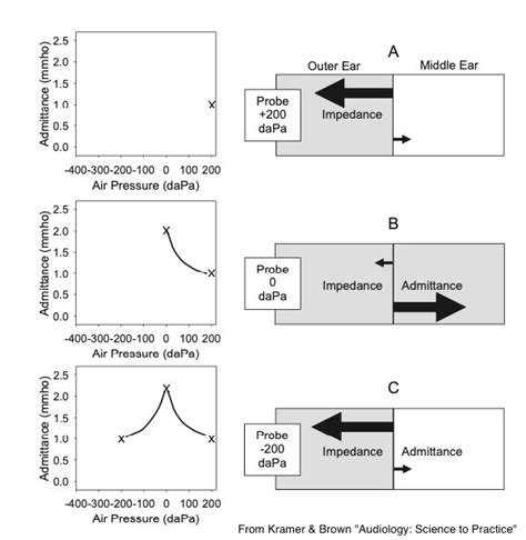 Tympanometry Test Normal Range At Kathleen States Blog