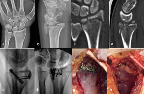 A B Dorsal Radiocarpal Fracture Dislocation C D Preoperative Ct Scan Download Scientific