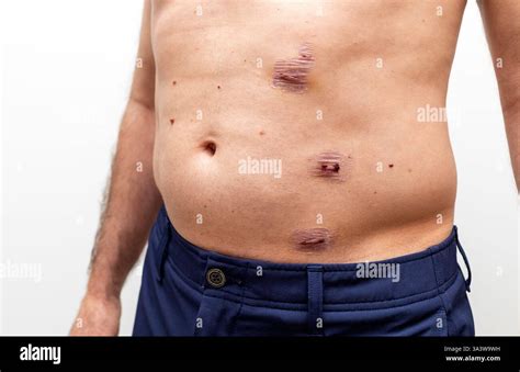 Closeup Scars On Abdomen After Removal Of Appendicitis And Abdominal Surgery Inflammation Of
