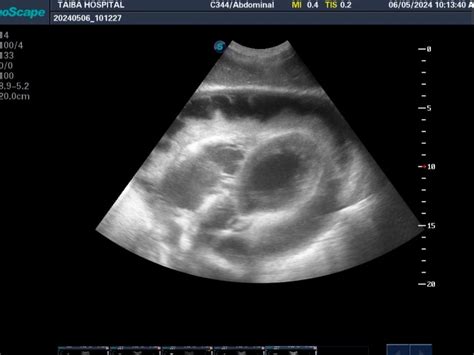 Muthab Suliman On Linkedin Case Number 1️⃣ ∆ Subxiphoid View Using Curve Linear Ts Moderate…