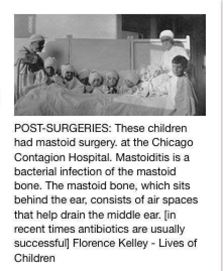 Mastoiditis Surgery Post Surgery Middle Ear Surgery