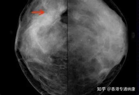 Ds 8201enhertu德喜曲妥珠单抗非小细胞肺癌疾病控制率923 知乎