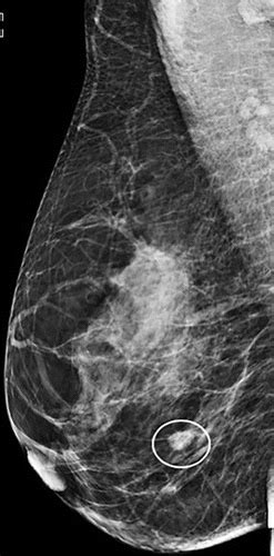 Clustered Microcysts At Breast Us Outcomes And Updates For Appropriate Management