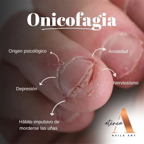 ¿sabías Que La Onicofagia El Hábito De Morderse Las Uñas Puede