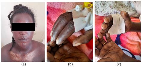 A Diffuse Hyperpigmentation With Hypopigmentation Around The Chest