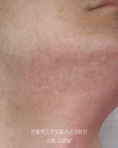 남자 수염레이저 제모 젠틀맥스프로플러스 5회 솔직 후기 네이버 블로그