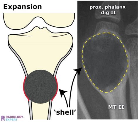 Bone Tumours