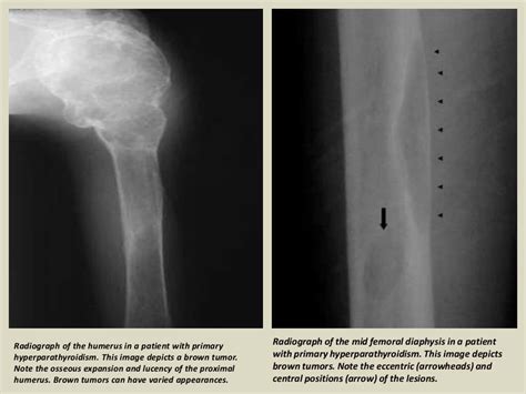 Hyperparathyroidism X Ray