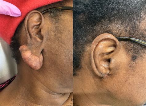 How Effective Are Keloid Ear Treatments London Keloid Scar Clinic