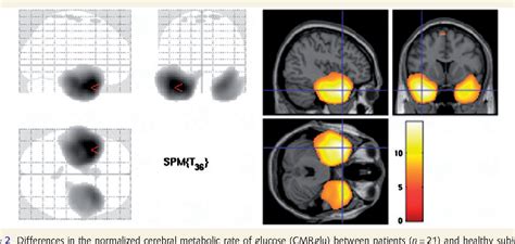 Figure 2 From What The Left And Right Anterior Fusiform Gyri Tell Us About Semantic Memory