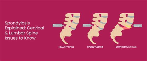 Spondylosis Symptoms Causes Treatment And Rehabilitation