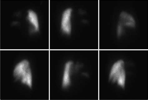 Perfusion Ventilation Scintigraphy Showing Segmental Perfusion Defects Download Scientific
