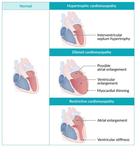 Patho Exam 4 Flashcards Quizlet