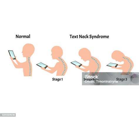 부적절한 자세 증상 무대 텍스트 목 증후군 척추 곡률 척추 후만증 척추 증 척추측만증 관절염 부적절한 자세와 구부리기 인포 그래픽 격리된 배경에 대한 벡터 그림입니다