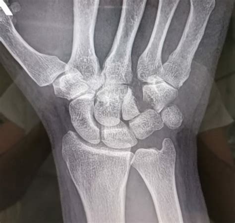 Hamate Fracture X Ray At Rodney Murphy Blog