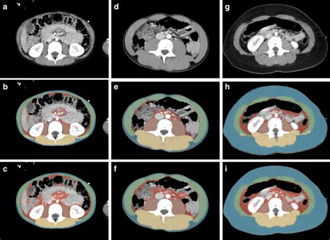 Pediatric Body Composition Based On Automatic Segmentation Of Computed Tomography Scans A Pilot