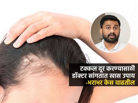टक्कल पडलं वय जास्त दिसतं आयुर्वेदीक डॉक्टर सांगतात १ उपाय करा भरभर वाढतील केस Marathi News
