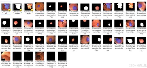 基于yolo11深度学习的胃肠道息肉智能检测分割与诊断系统【python源码pyqt5界面数据集训练代码】深度学习实战、目标分割、人工