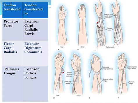 Peripheral Nerve Injuries Pptx