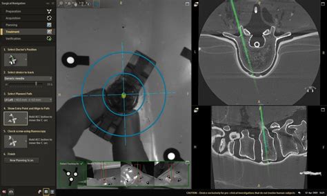 Philips Introduces Augmented Reality Surgical Navigation Solution In Japan Applied Radiology