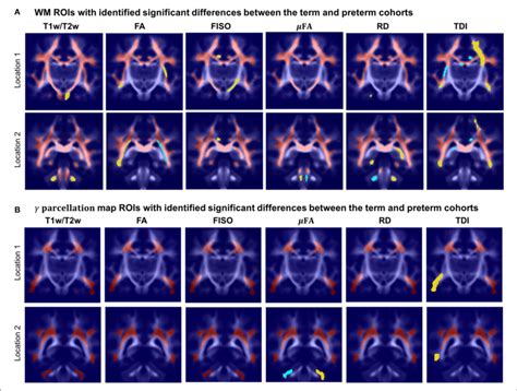 Atlas Based Region Specific Analysis The Regions Significantly Download Scientific Diagram