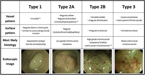 Narrow‐band Imaging Nbi Magnifying Endoscopic Classification Of