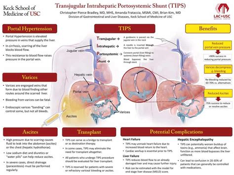 Transjugular Intrahepatic Portosystemic Shunt Tips American Liver