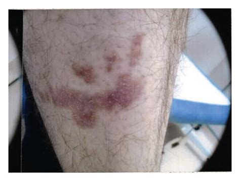 A 7 Cm Irregular Scaly Pink Brown Plaque Of Giant Dermatofibroma With