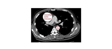 Ascending And Descending Aorta On Ct