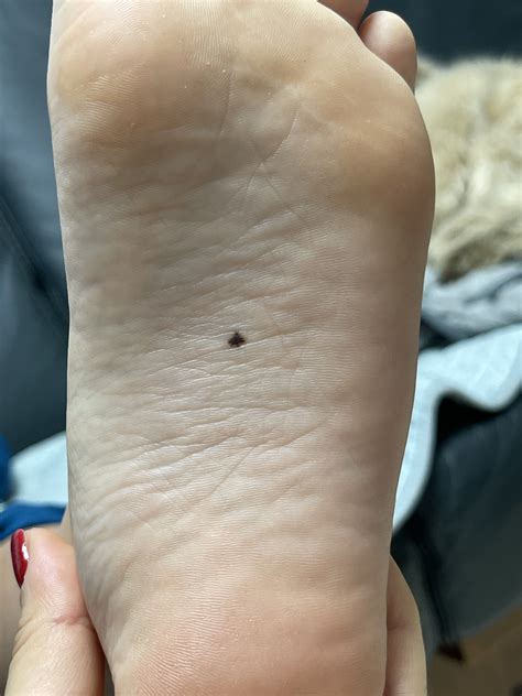 발바닥 점 흑색종 일까요 어느 병원으로 가야 하나요 ㅣ 궁금할 땐 아하