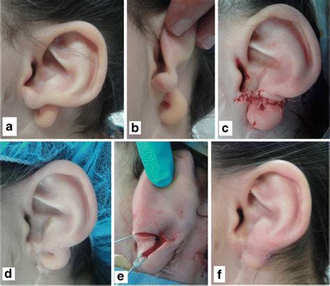 Case Number 2 Left Ear A B The Deformity C Staged Transposition Of