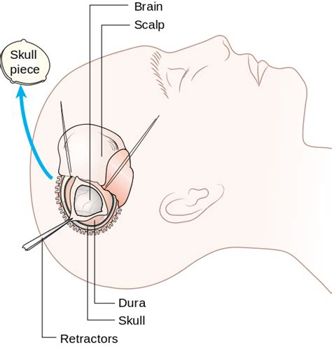 Craniotomy Physiopedia