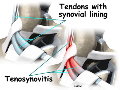 Peroneal Tendon Osteopath In Hatfield
