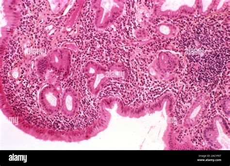Inflamed Gallbladder Light Micrograph Of A Section Through A