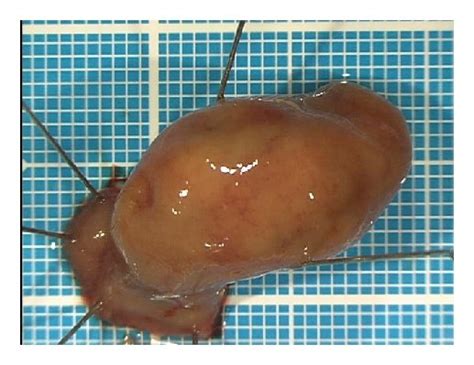 Endoscopic Resection Of The Polyp During The Procedure The Stalk Was