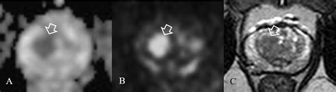 Index Lesion Detection In Multifocal Prostate Cancer Simplified Pi