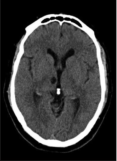 Surgical Neurology International